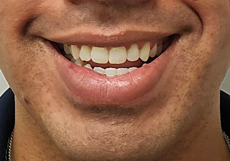 Why Smile Set? – SmileSet