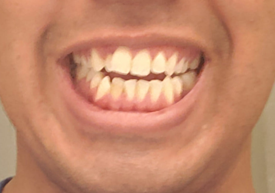 Why Smile Set? – SmileSet