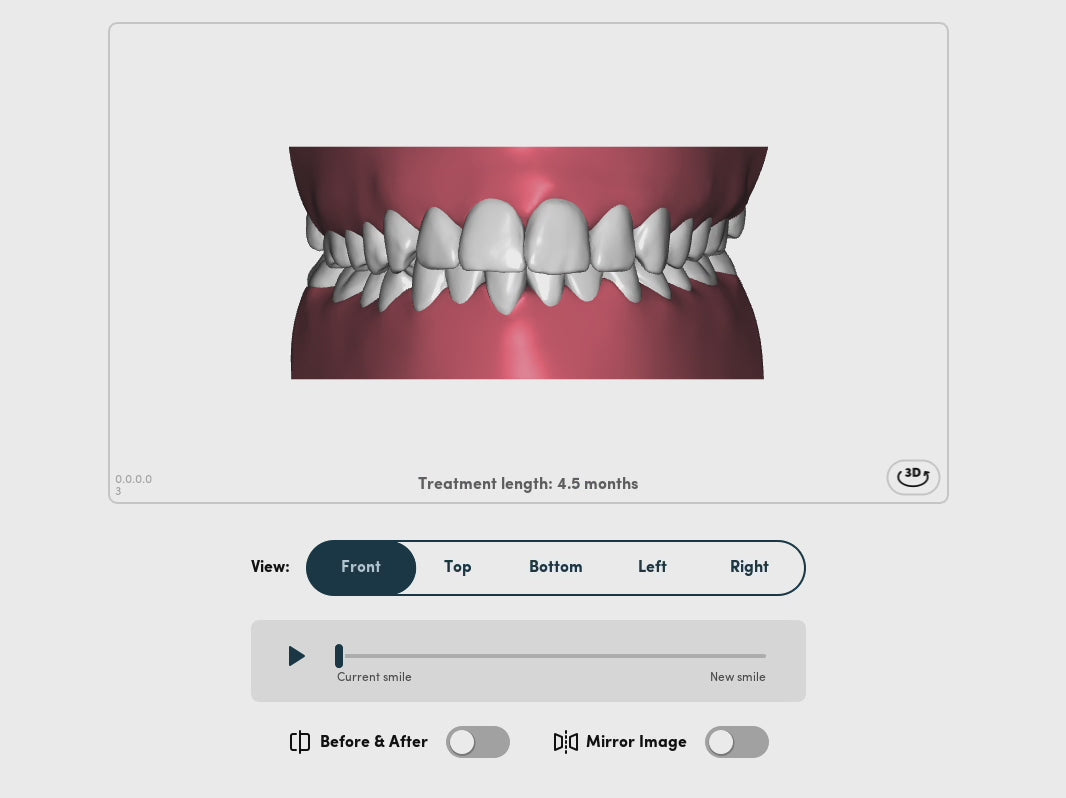 Impression Kit First - Aligner Treatment – SmileSet
